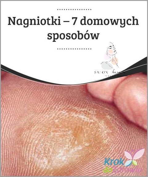 7 Domowych Sposobów Na Nagniotki! - [Zaktualizowano maj 2026 ...