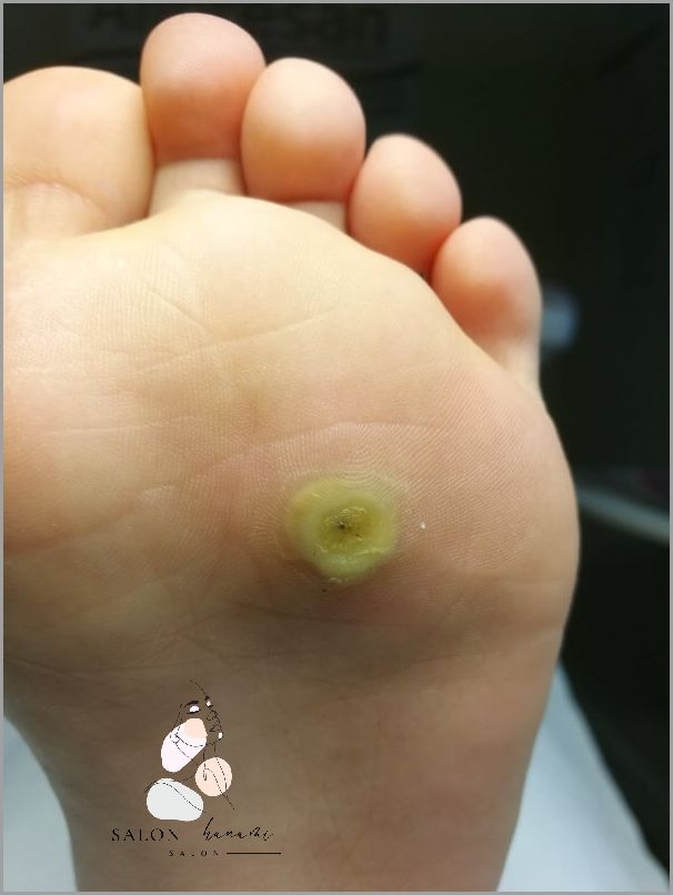 Usuwanie Odcisków Z Korzeniem - Sprawdź Jak! - [Zaktualizowano ...