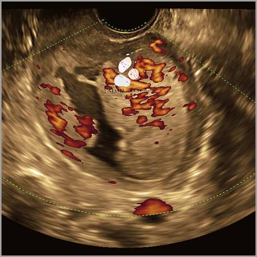 Szokujący Obraz Ciałka Żółtego Na USG! - [Zaktualizowano grudzień 2025 ...